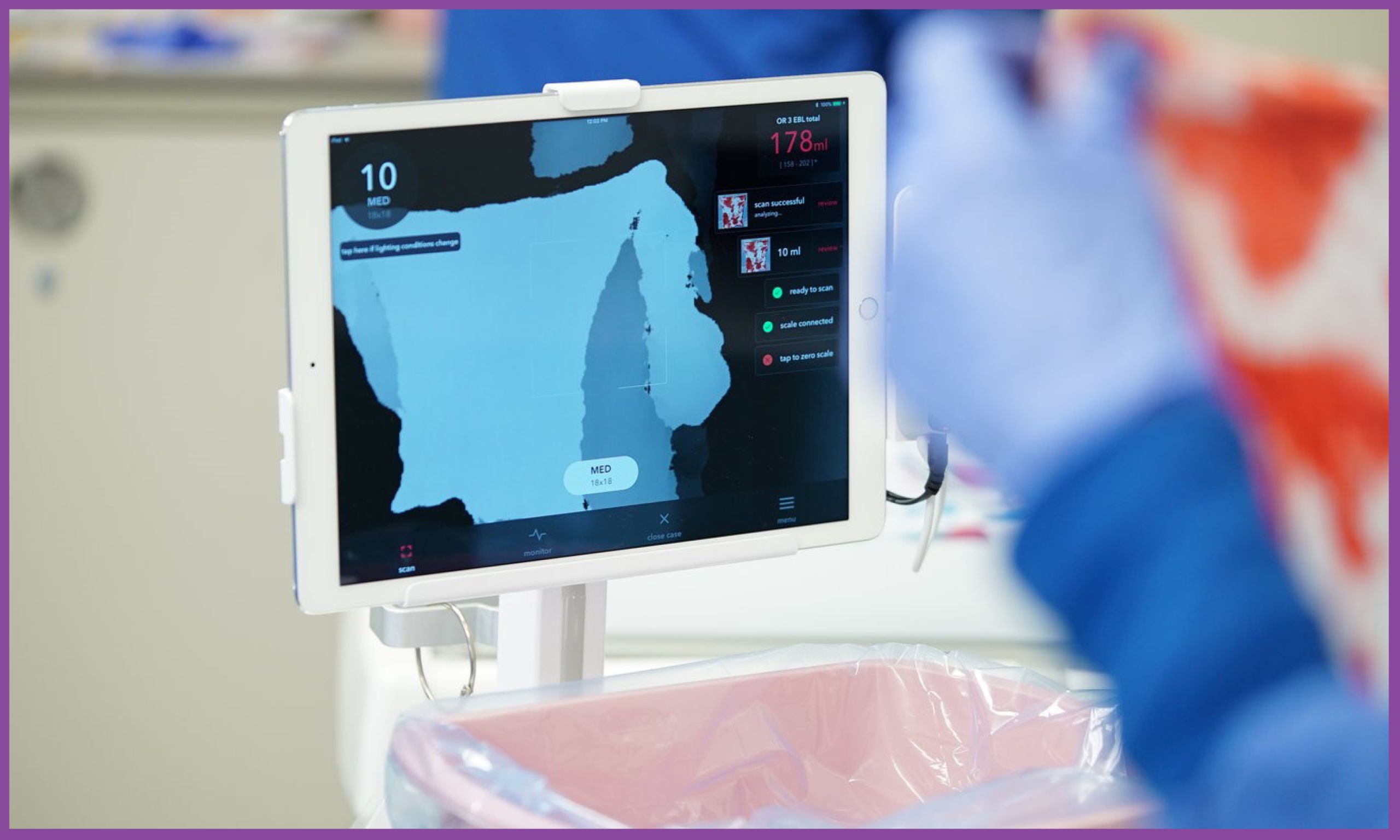 New technology tracks blood loss, reduces transfusions